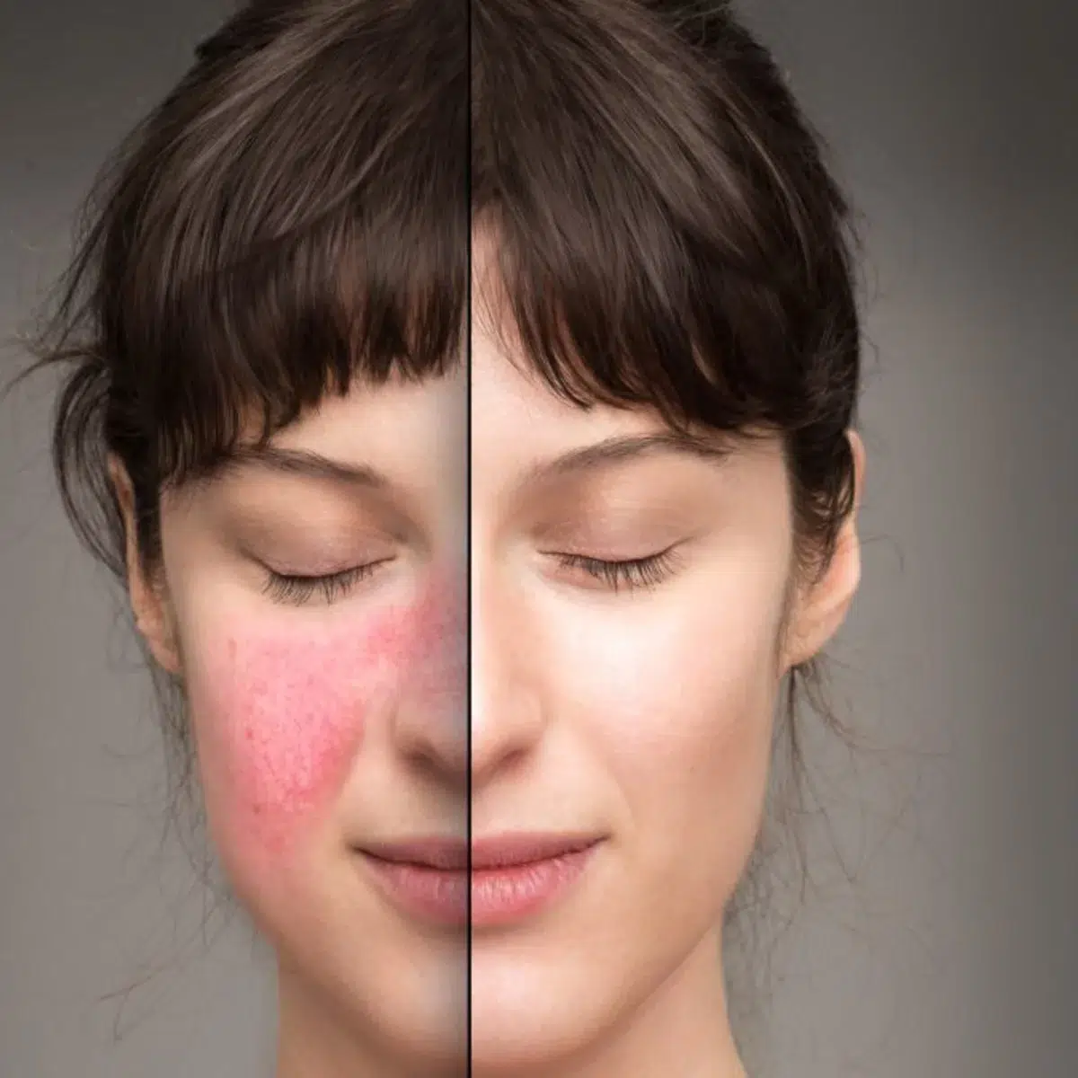 Understanding Rosacea: Symptoms, Causes, Triggers & Treatment - Cole ... Understanding Rosacea: Symptoms, Causes, Triggers & Treatment - Cole ...